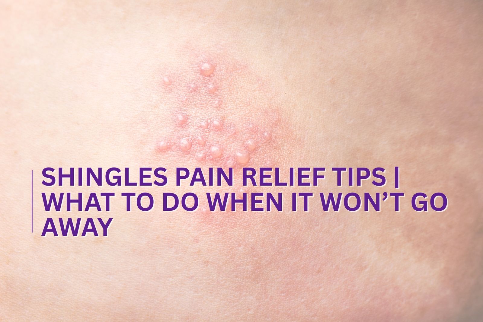 Shingles & Nerve Pain: How to Find Lasting Relief
