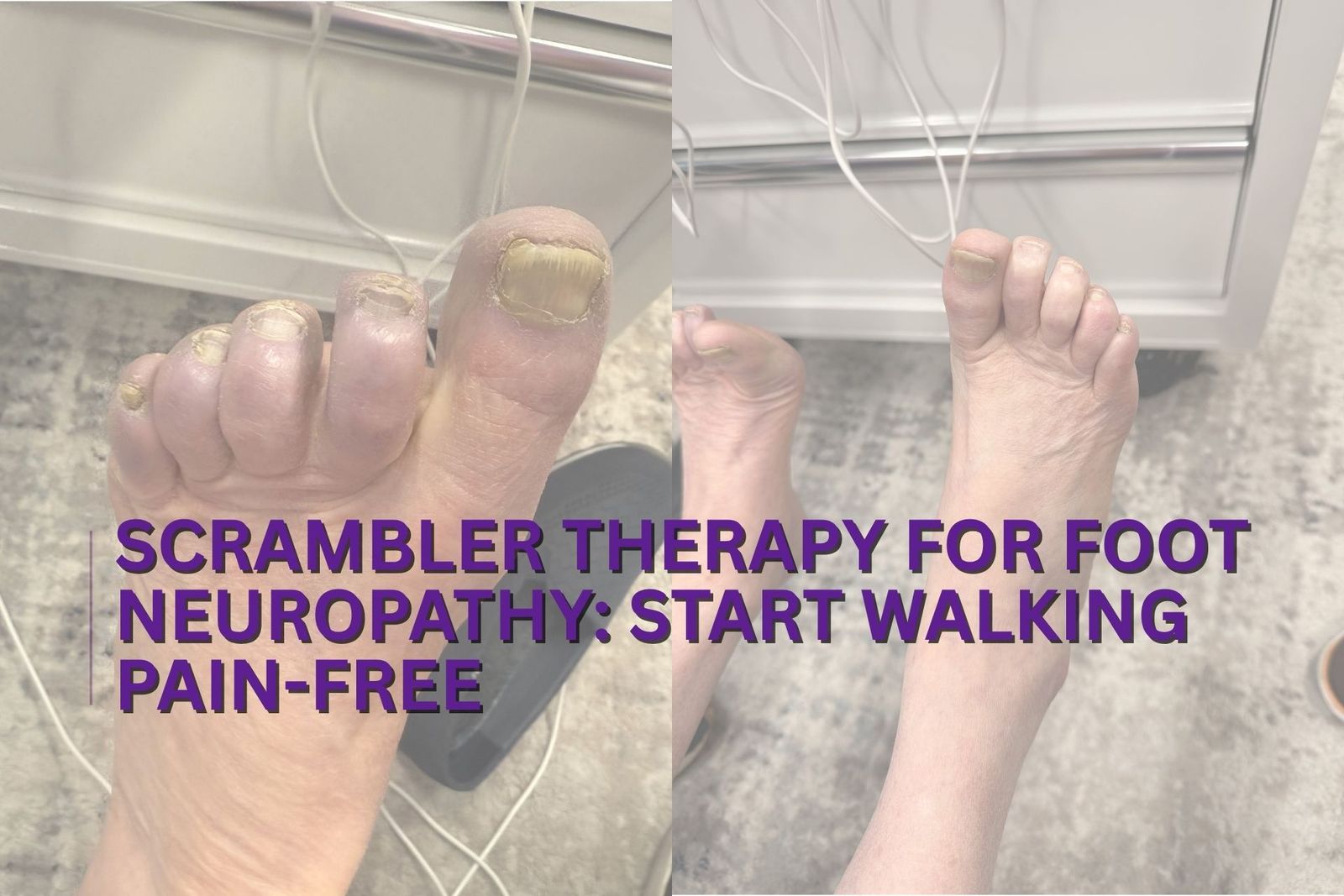 Scrambler Therapy for Foot Neuropathy: Start Walking Pain-Free