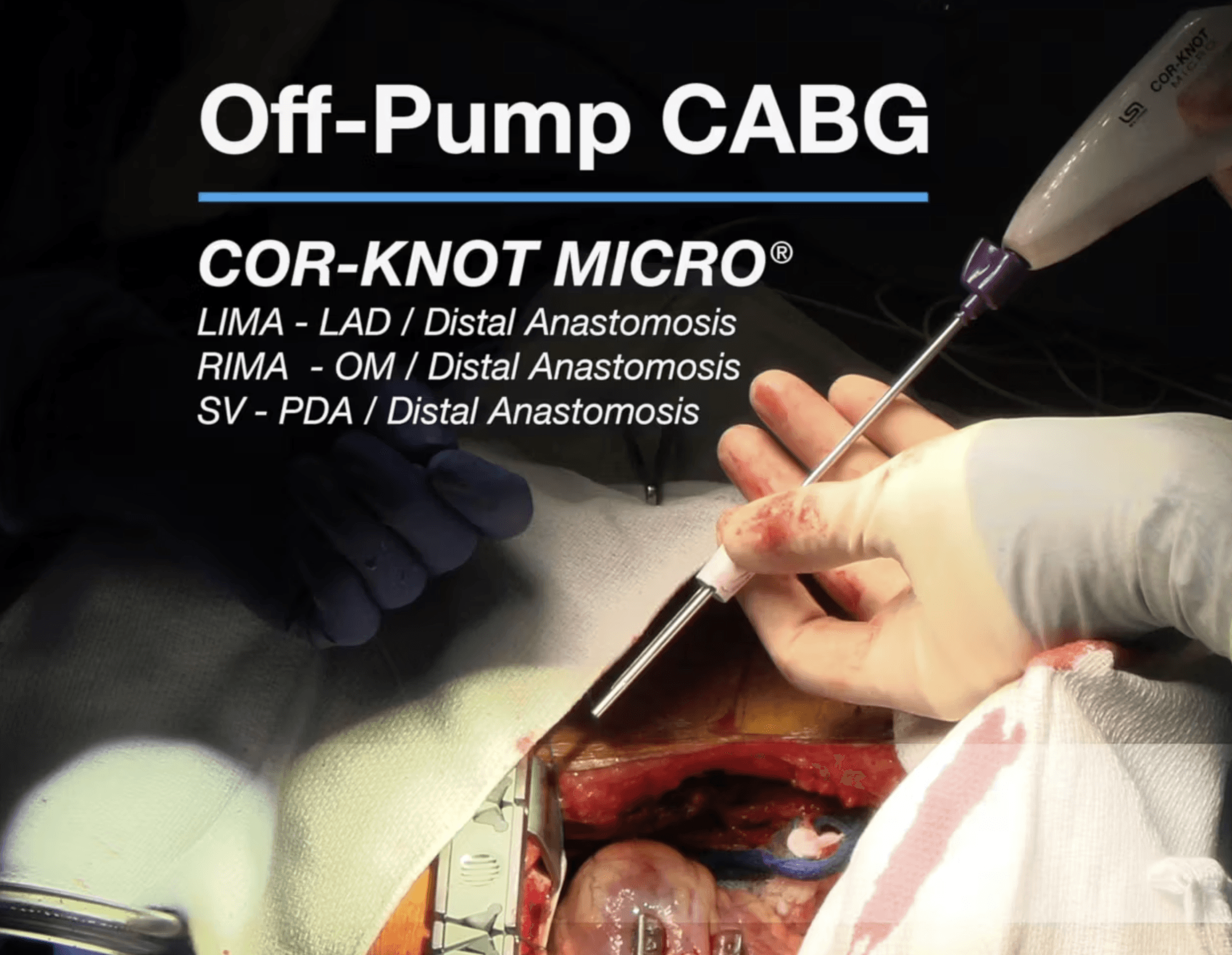 COR-KNOT MICRO® | LSI SOLUTIONS®