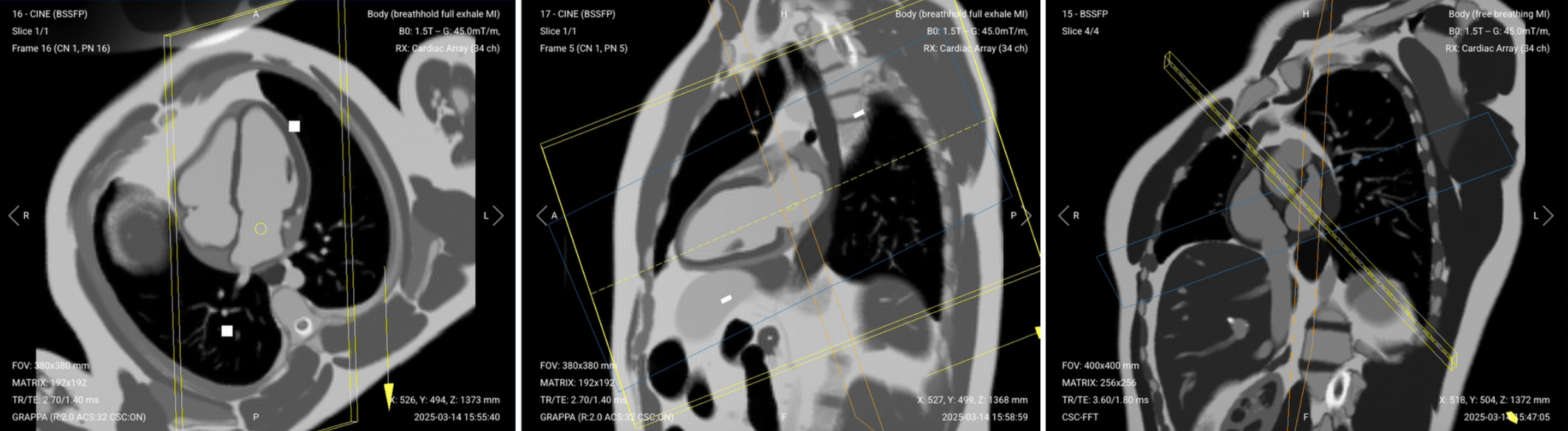 How to Scan a Cardiac MRI Viability/MI Protocol (Part 1) – EASY Video Guide