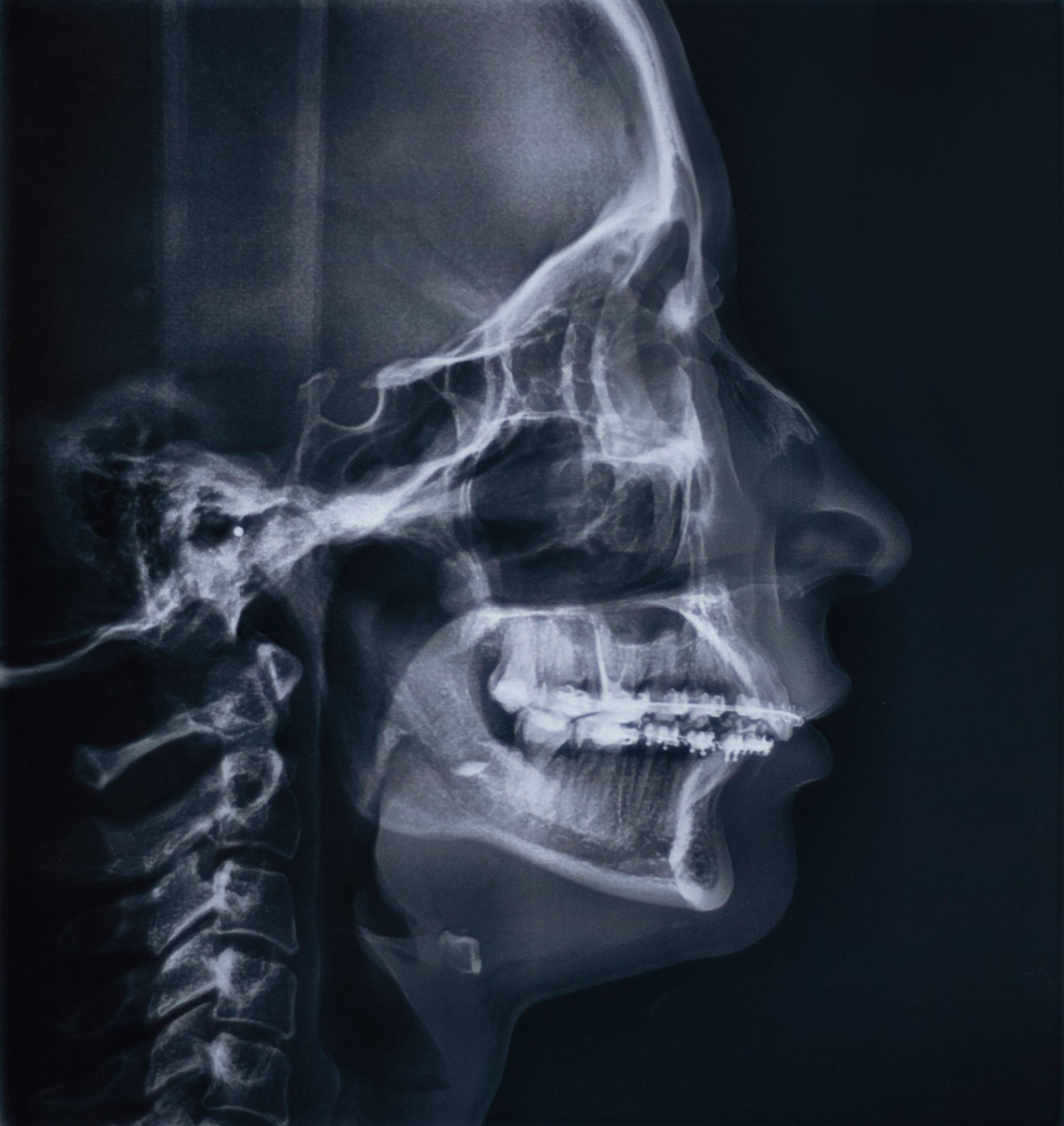 Unlocking Smiles: The Essential Guide to Cephalometric X-Rays in Modern ...