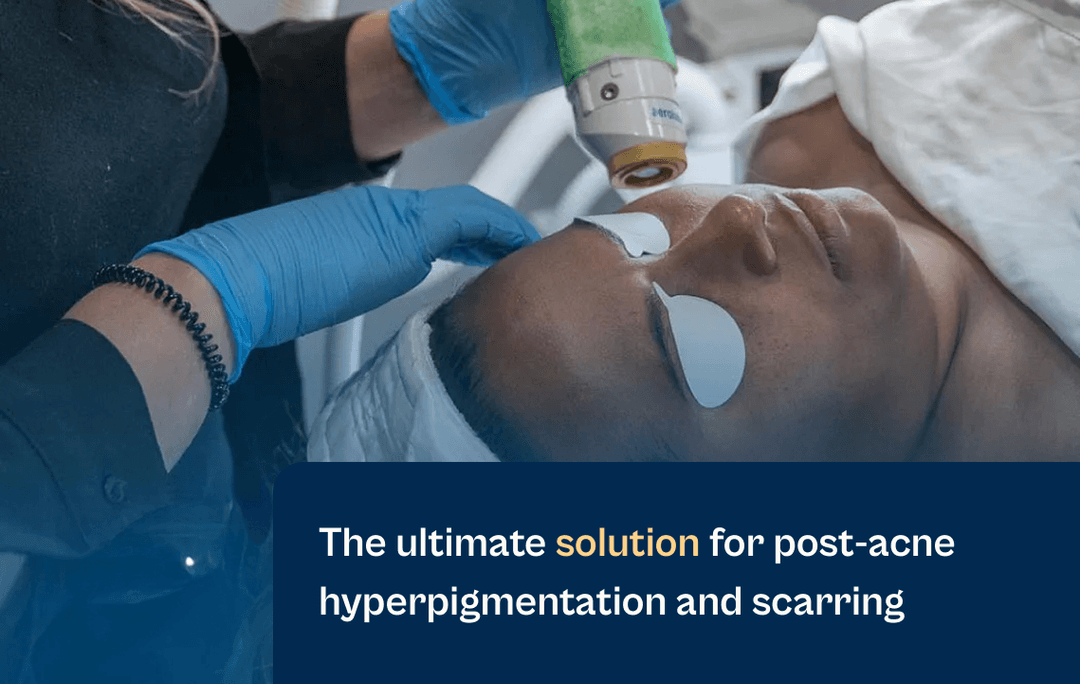 The Ultimate Solution for Post-Acne Hyperpigmentation and Scarring