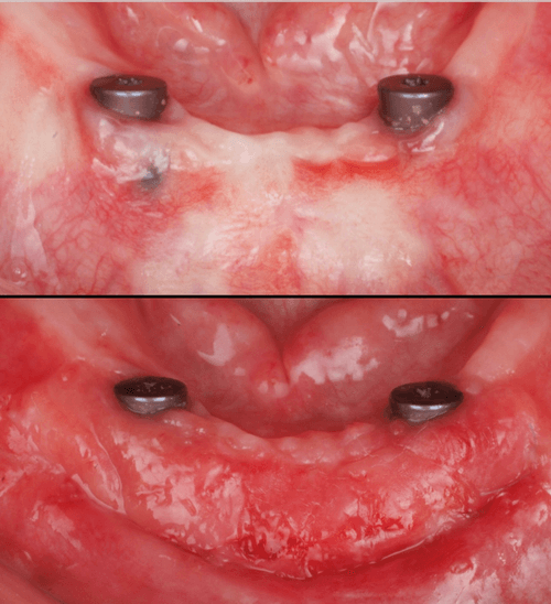 Soft Tissue Mastery in Full-Arch Implant Dentistry - Predictable ...