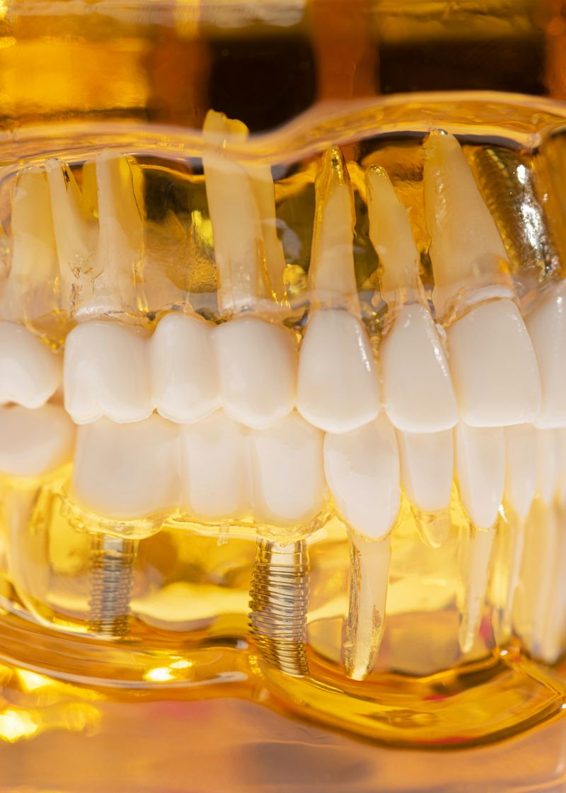 Onlays vs. Crowns: Which One is Right for Your Smile?
