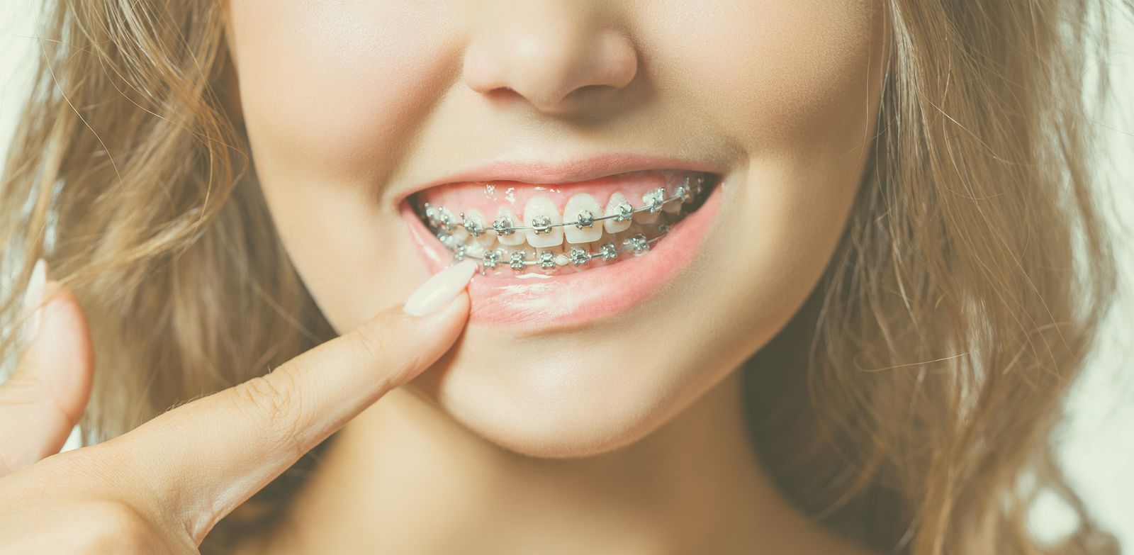 Cleaning your braces and teeth | Brace