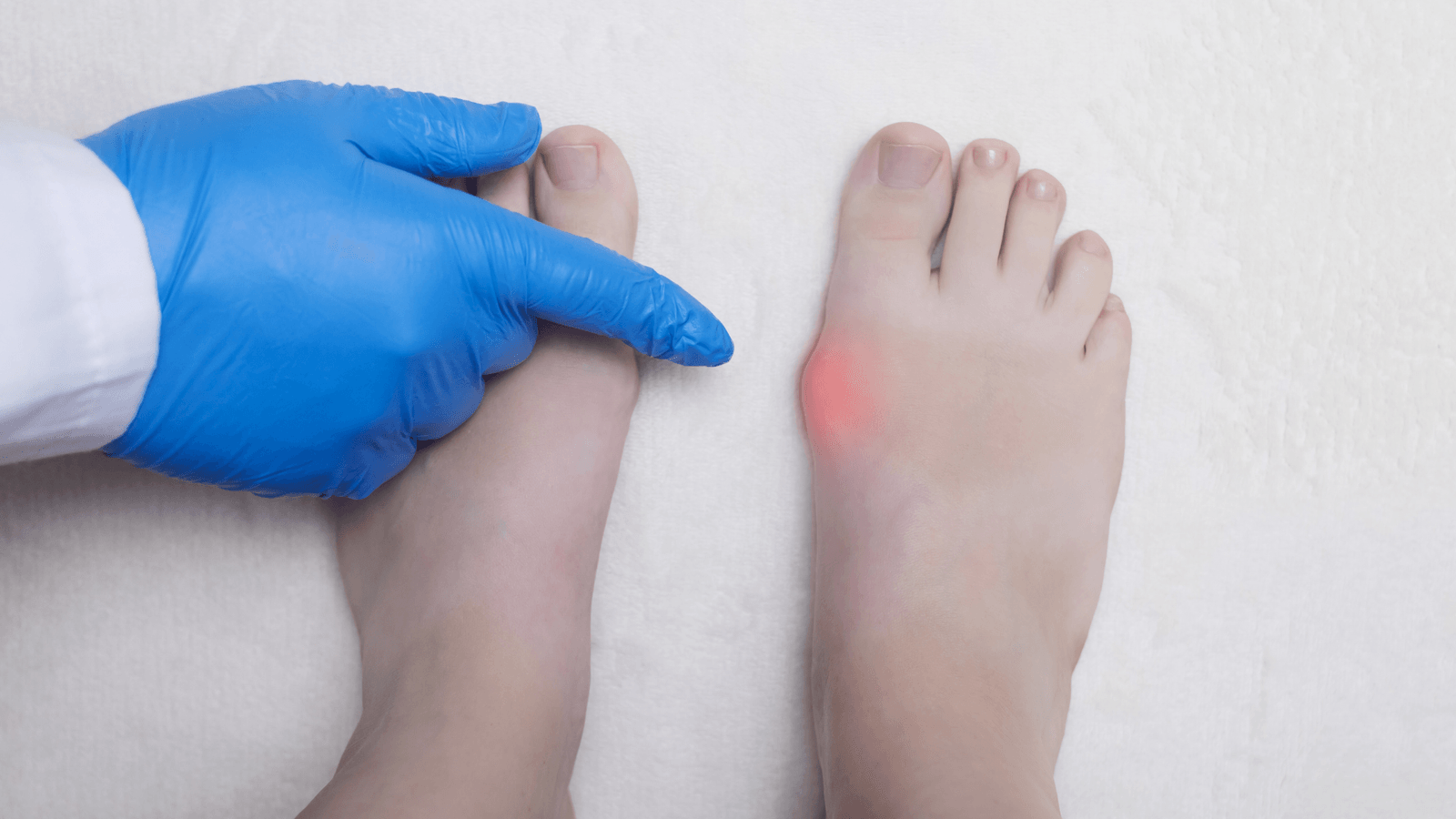 Bunion Surgery Recovery Timeline | FAS The Woodlands