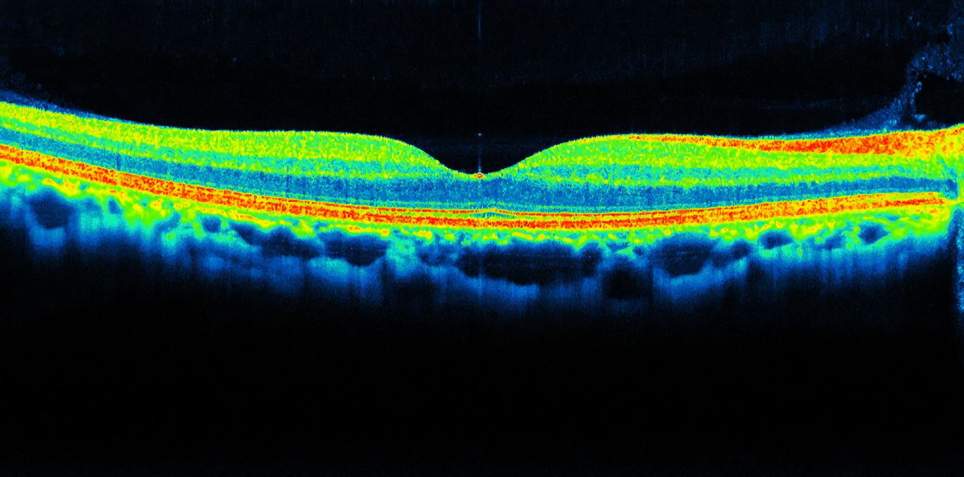 OCT (Optical Coherence Tomography) Advanced Eye Scan In Belfast ...