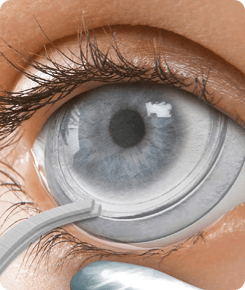 Prokera Treatment - Miami Contact Lens Institute