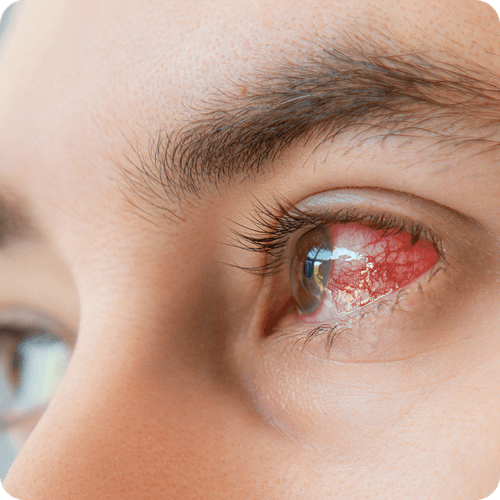 Eye Treatment for Sjogren’s Syndrome
