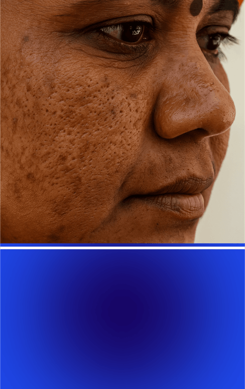 Lichen Planus Pigmentosus: Symptoms, Causes, and Treatments