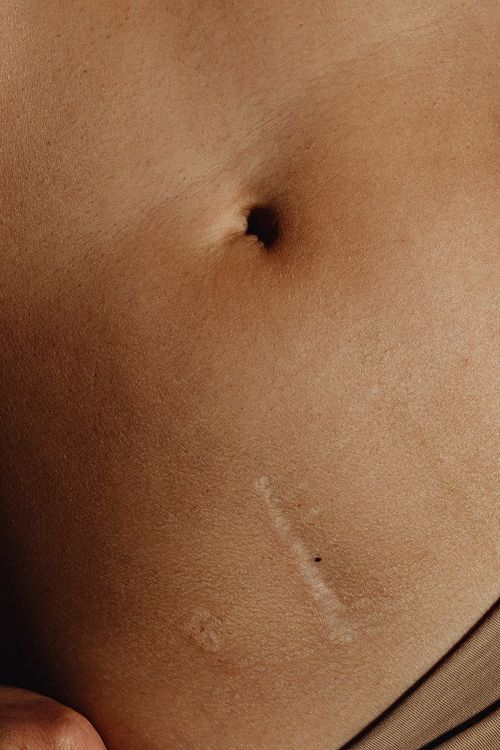 Scar Treatment 101: What Are the First Steps? | Daniels Group Plastic ...