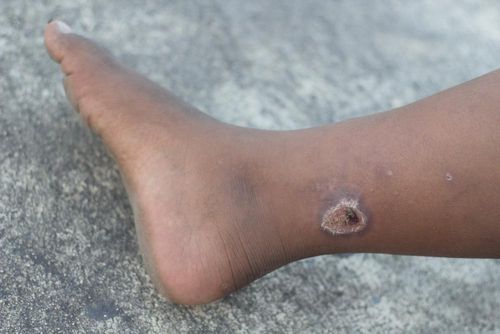 Venous-Statis Wounds: What is the Diagnosis & Treatment