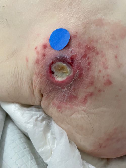 Diagnosis And Treatment Of Periwound Skin Dermatitis