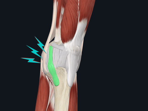 The Complete Guide to an MCL Tear