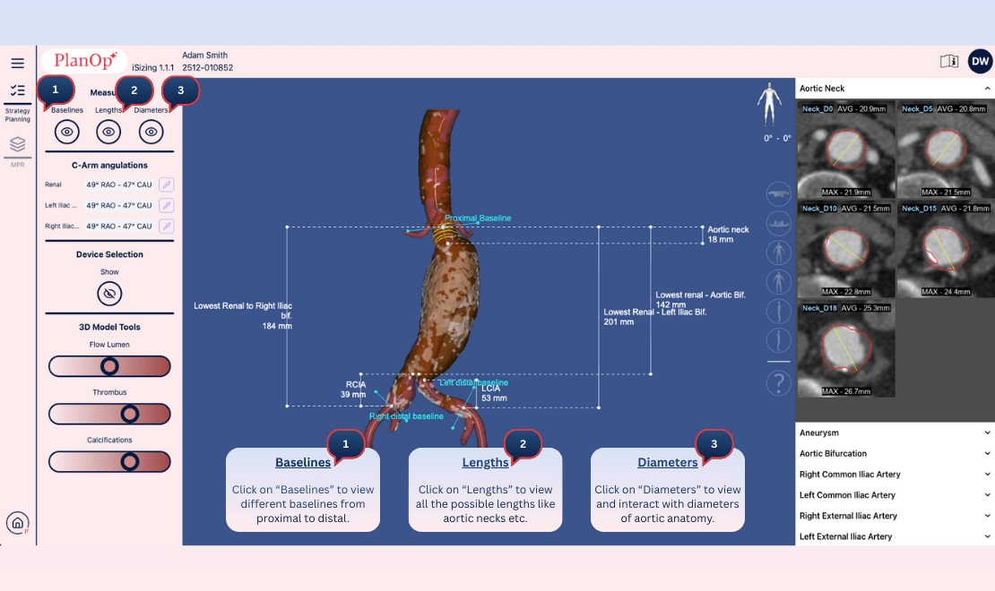 PrediSurge | iSizing in practice